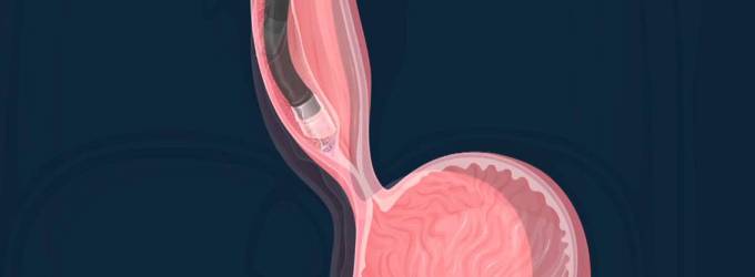 Endoscopia en la enfermedad de Crohn: información general - Guía tu cuerpo