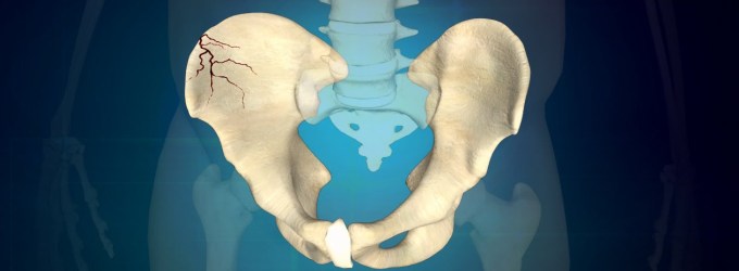 Fracturas De La Pelvis | Fractura de Pelvis – LGYC