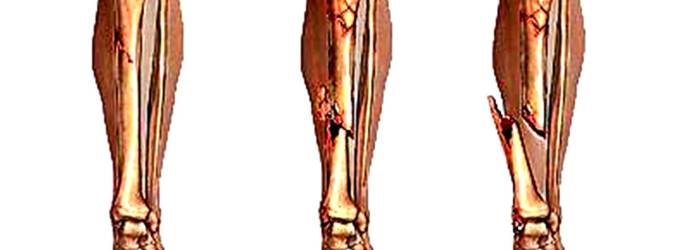 Los diferentes tipos de fracturas (imágenes) - Guía tu cuerpo