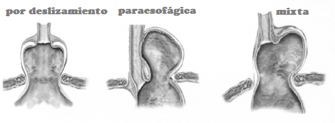 Hernia De Hiato Esofagico – Hernia de hiato: Causas, síntomas ...